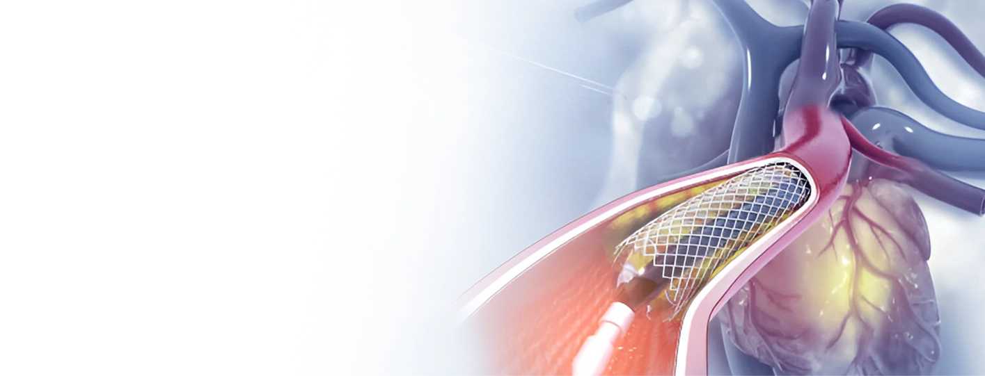 Latest Advances in Angioplasty & Heart Care | Artemis Cardiac Care