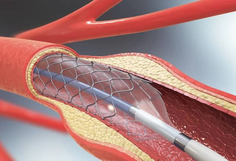 CT Angiography vs Traditional Angio: Which Heart Scan is Best?