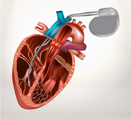 Best Pacemaker Implantation Surgery : Pacemaker Implantaion Cost ...