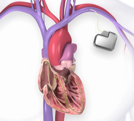 Best Pacemaker Implantation Surgery : Pacemaker Implantaion Cost ...